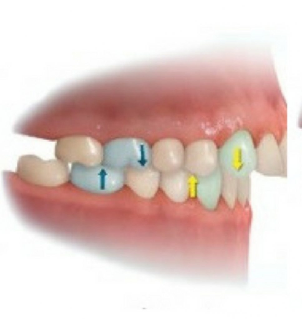 ¿Qué es la oclusión dental y que tipos existen? | Caraterísticas