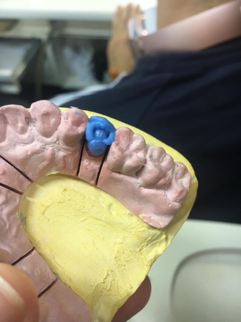》Tallado dental y principios para la preparación de pilares